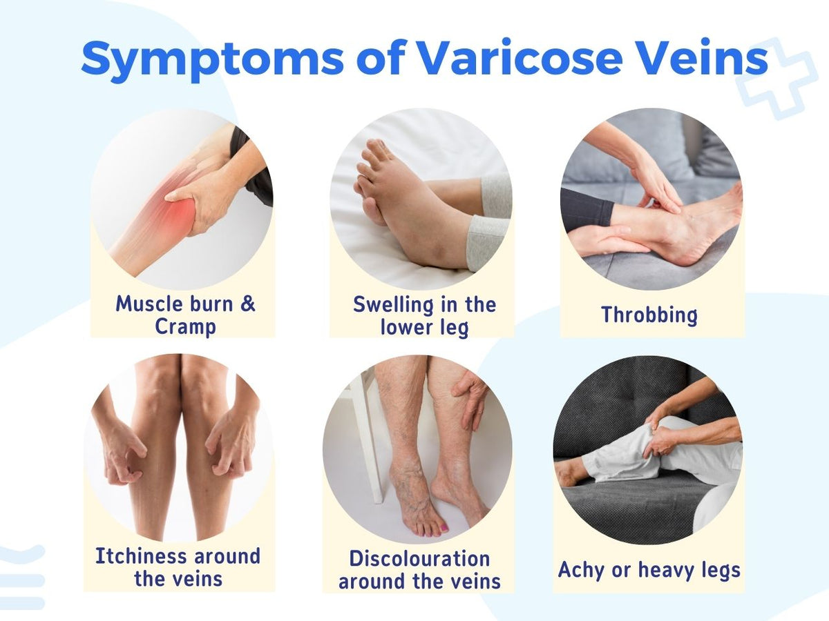 Varicose Veins Facts that You Need to Know | US CLINICALS
